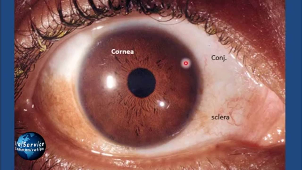 LA CORNEA E IL CHERATOCONO - YouTube