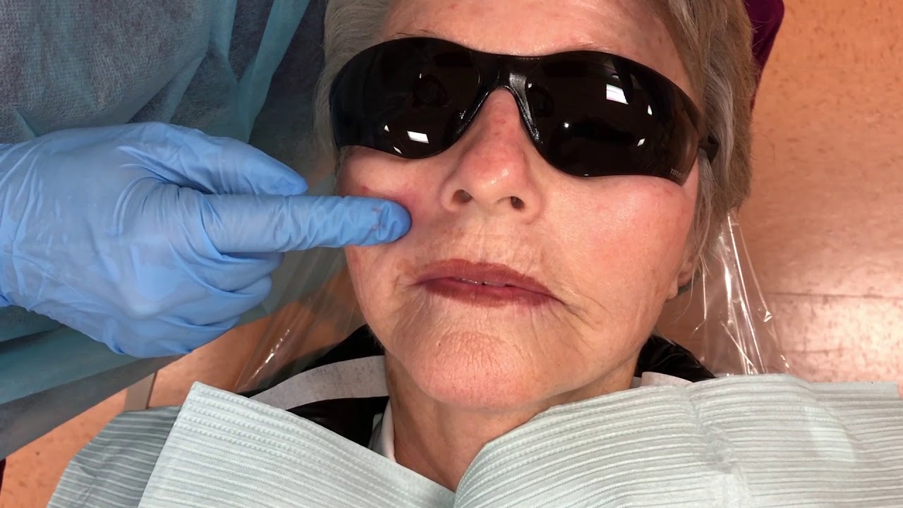 Anterior Superior Alveolar and Infraorbital Nerve Blocks - YouTube