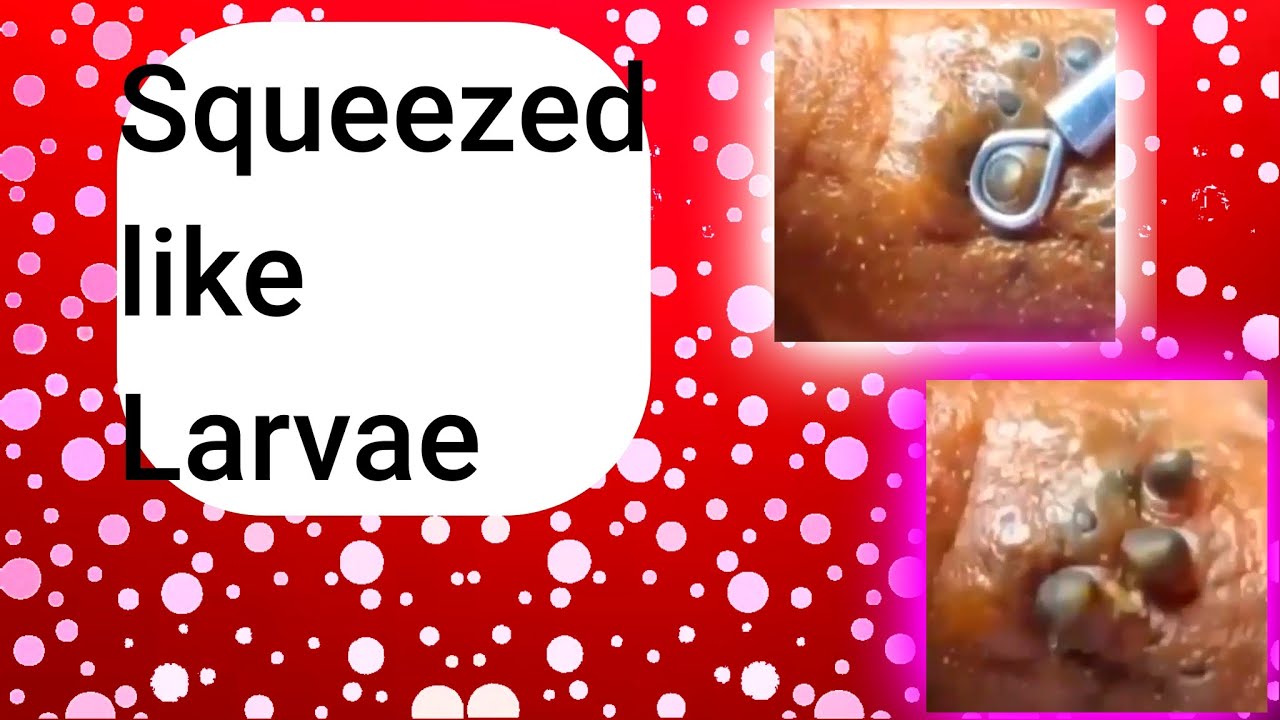 Satisfying video Pimple popping Compilation #8| Abscess, Cyst popping ...