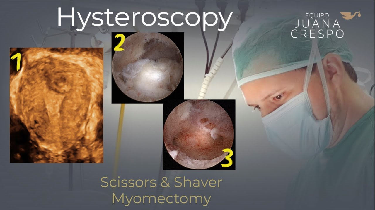 Scissor & Shaver Myomectomy (with adenomyosis) - YouTube