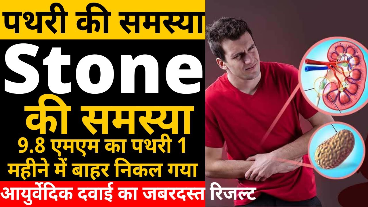 पथरी का सबसे सरल इलाज | pathri ka ilaj | kidney stone pain | pathri ...