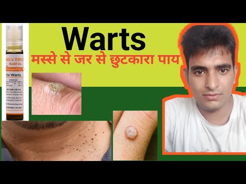 Thuja roll on Lotion/warts/मस्से को जर से छुटकारा पाय/Thuja roll on sbl ...