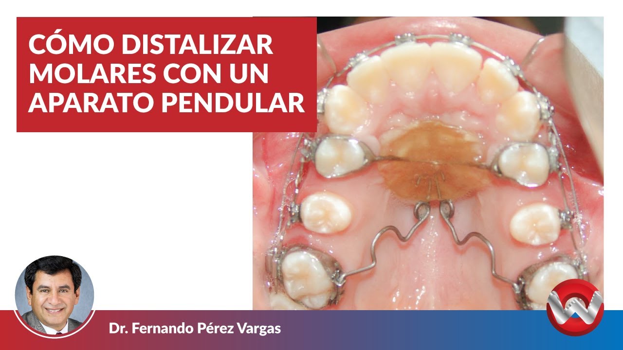 Distalización de molares con Aparato Pendular - YouTube