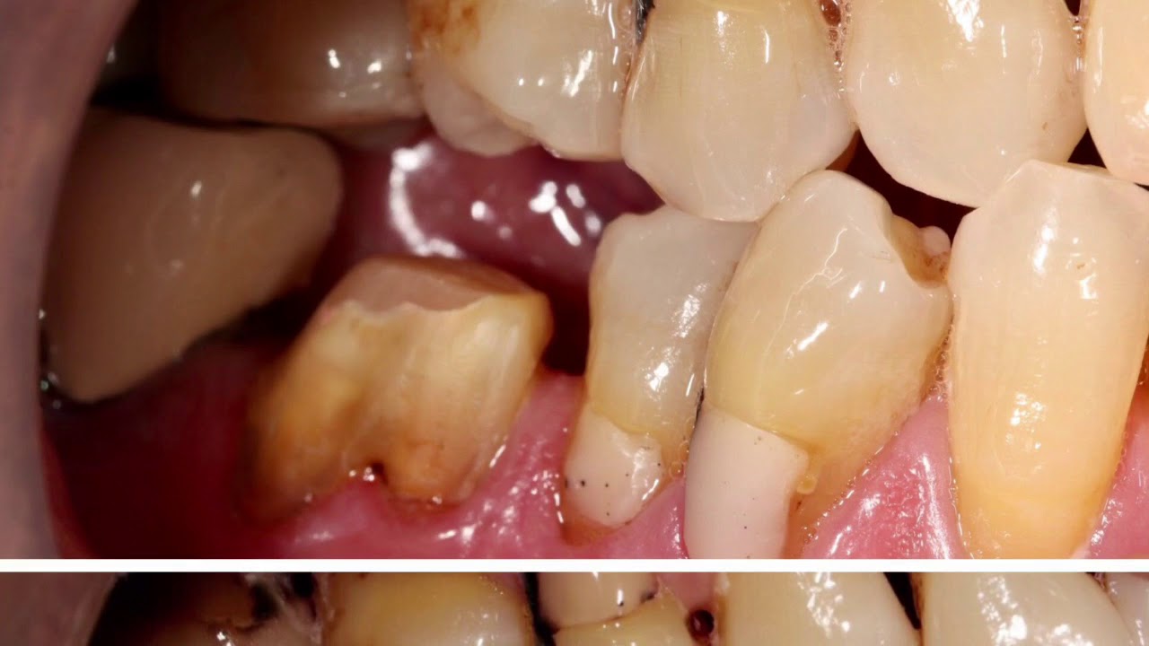 Single molar crown after endodontic in geriatric patient - YouTube