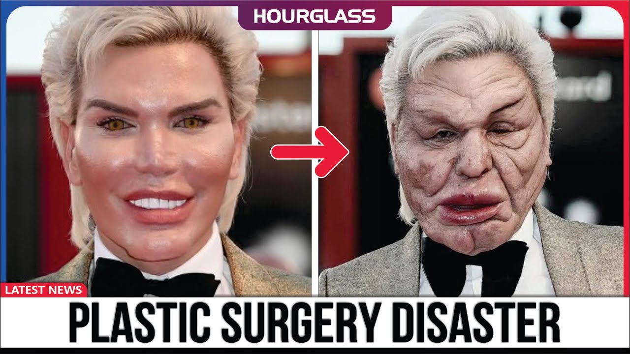 He Had Too Much Plastic Surgery And Now His FACE Is R.U.I.N.E.D - YouTube