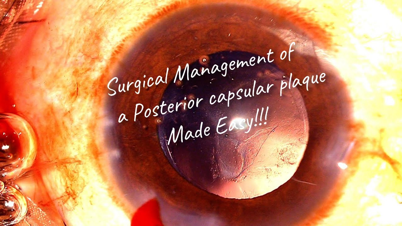 Posterior Capsular Plaque management made EASY - YouTube