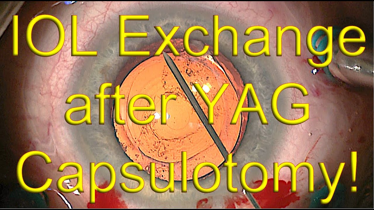 IOL exchange surgery (with open capsule after YAG capsulotomy) - Dr Simon Chen - YouTube