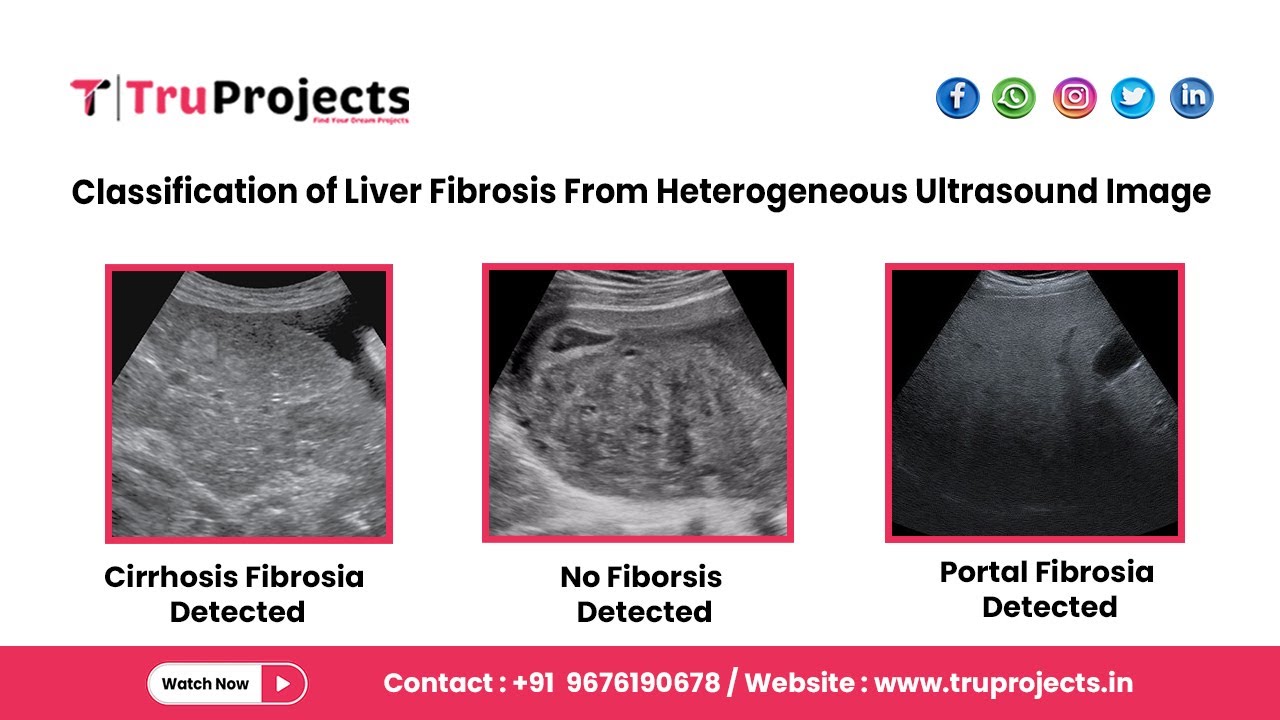 Classification of Liver Fibrosis From Heterogeneous Ultrasound Image ...