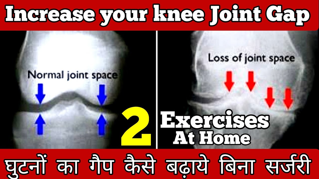 Increase your knee Joint Gap without Surgery 2 Best Exercises At Home ...