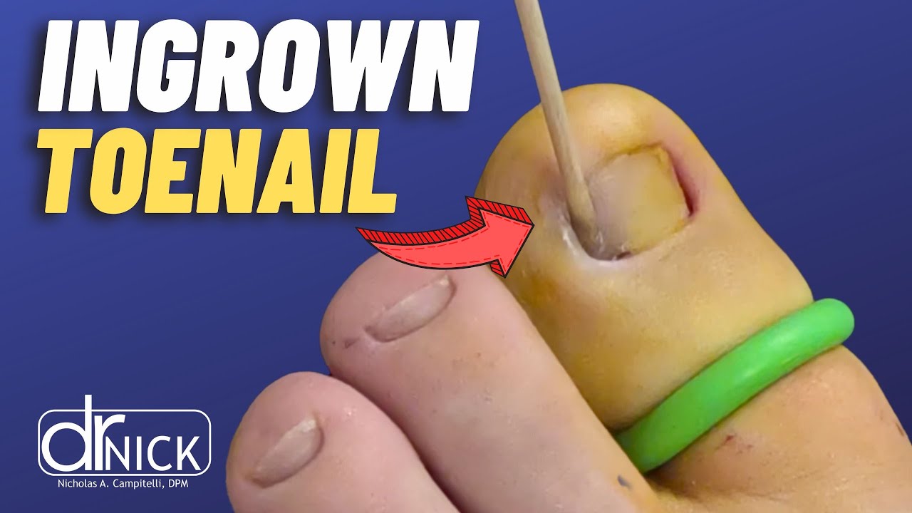 How to treat an ingrown toenail | Matrixectomy by Dr. Campitelli - YouTube