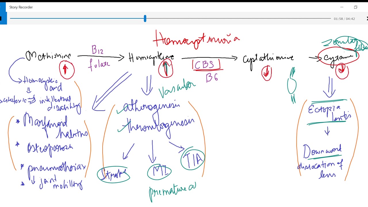 Homocystinuria explained clear and easy (vs marfan's) - YouTube