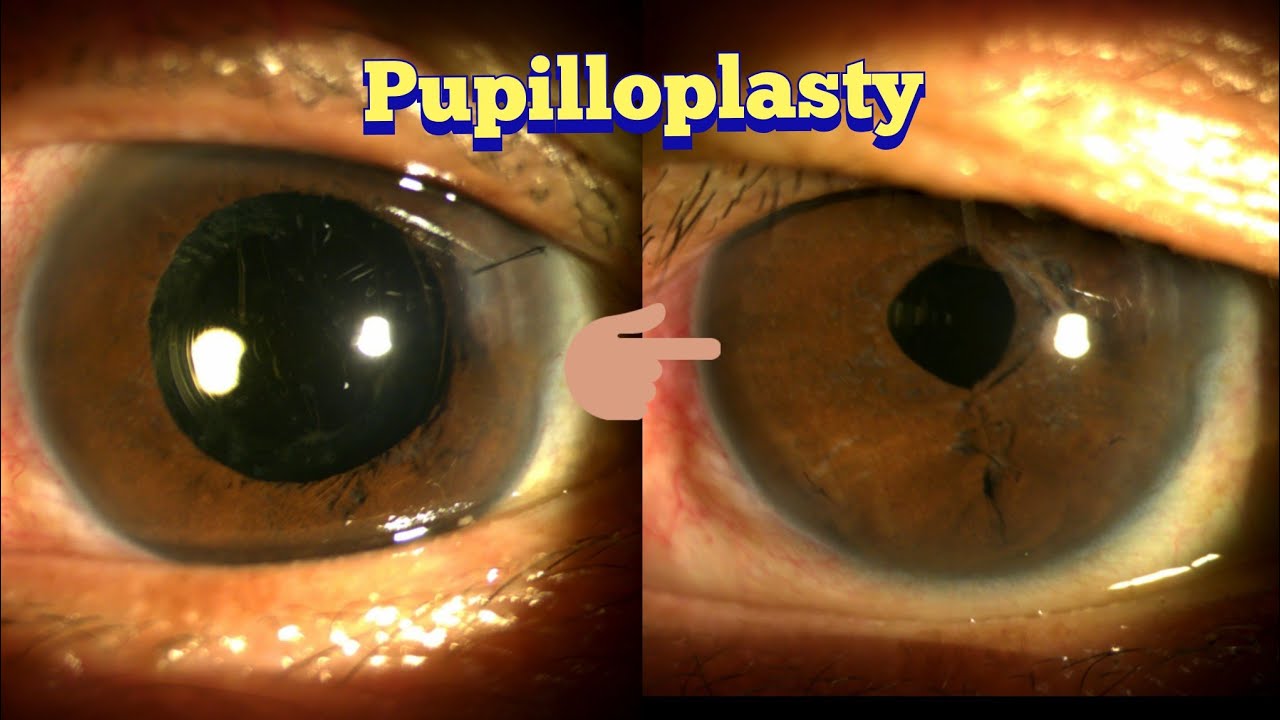 Pupilloplasty in mf-IOL implanted eye - YouTube