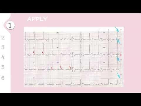 ECG secret codes: video 8: ECG interpretation, CODES 1,2,3 - YouTube