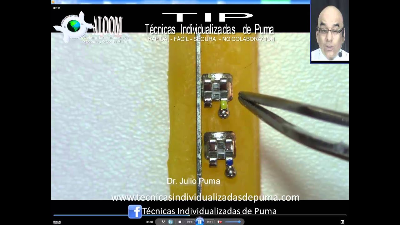Brackets de Arco Recto Roth 2-3 Curso Virtual de Ortodoncia - YouTube