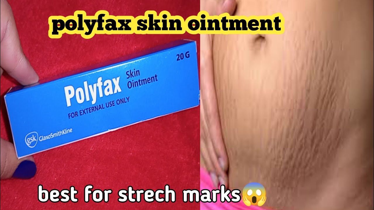 best cream for strech marks | polyfax skin ointment review - YouTube