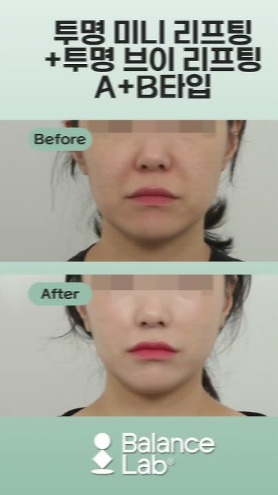 투명미니리프팅 투명브이리프팅 Ab타입 1달차💞 실리프팅 실리프팅후기 실리프팅전후 미니리프팅 미니리프팅후기 투명