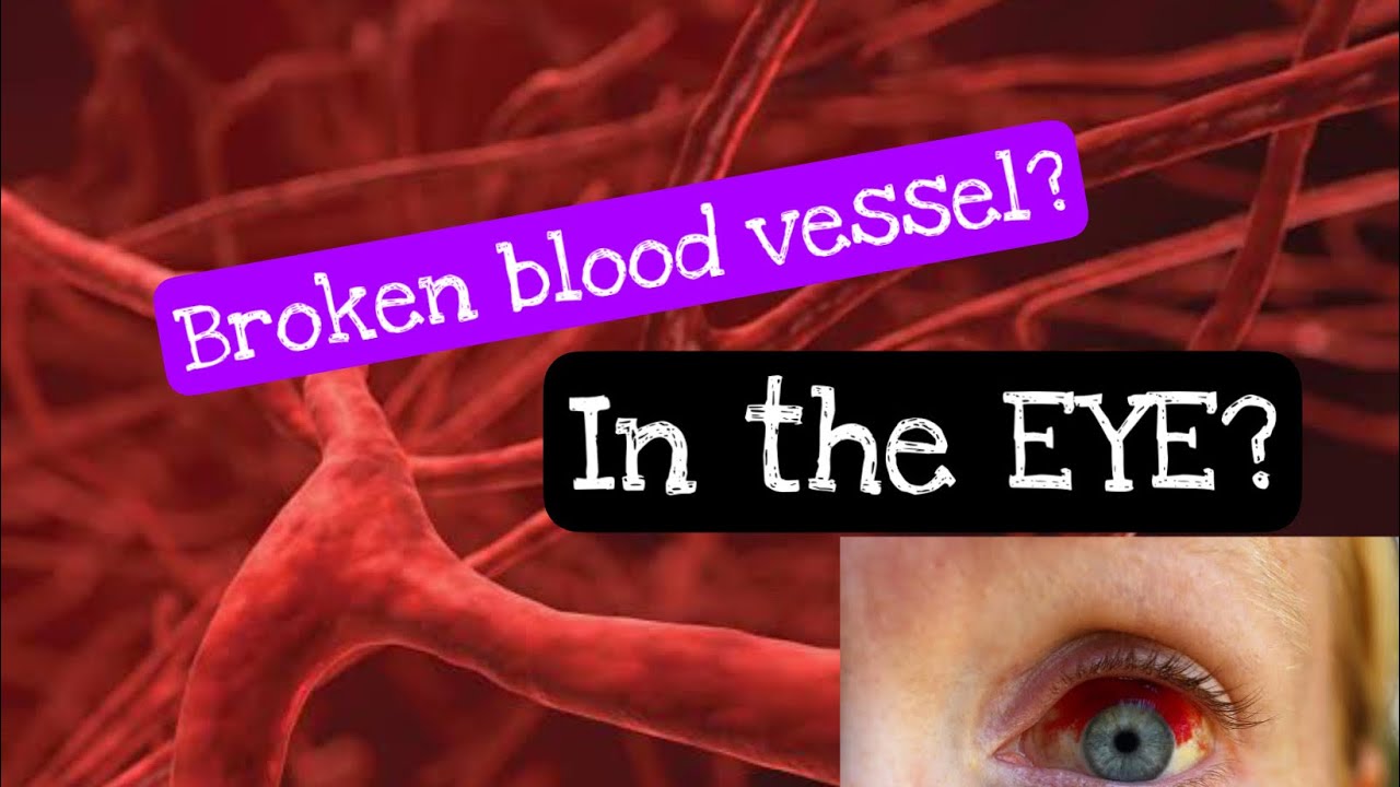 Why does BROKEN BLOOD VESSEL in the EYE happen? Prevention and ...