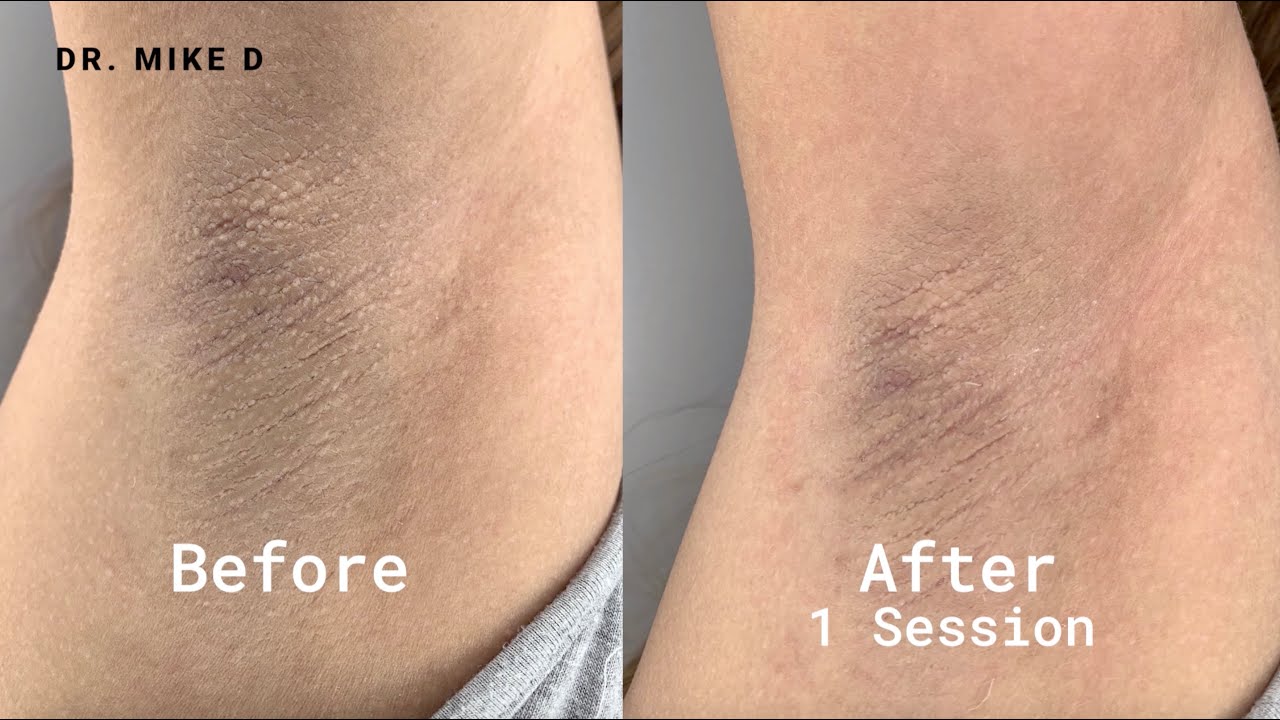 Dark Underarms Causes And How To Treat It Dr Mike D YouTube dark-underarms-causes-and-how-to-treat-it-dr-mike-d-youtube