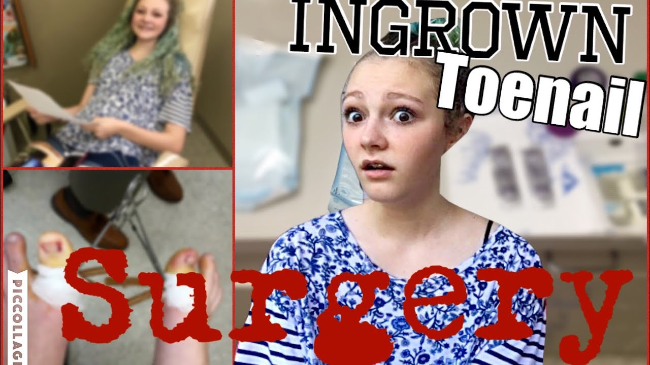 My Ingrown Toenail Surgery Experience... Not for the Squeamish ...