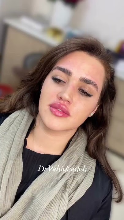 تزریق ژل لب Lip Filler Injection Lipfiller Lipstick Lipfillers ژللب لیفتصورت ژل Youtube