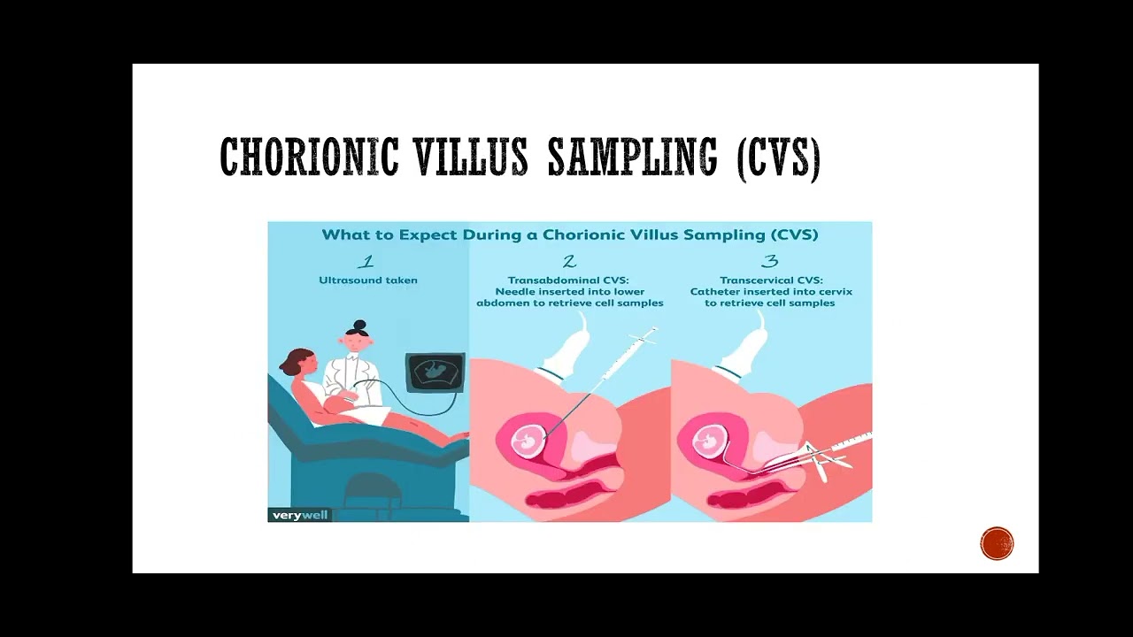 Chorionic villus sampling- Adithya MP - YouTube