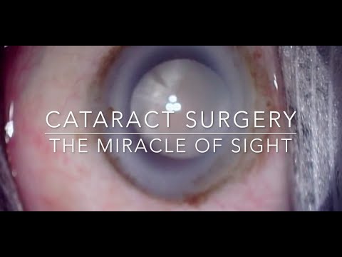 Cataract Surgery: The Miracle of Sight - YouTube
