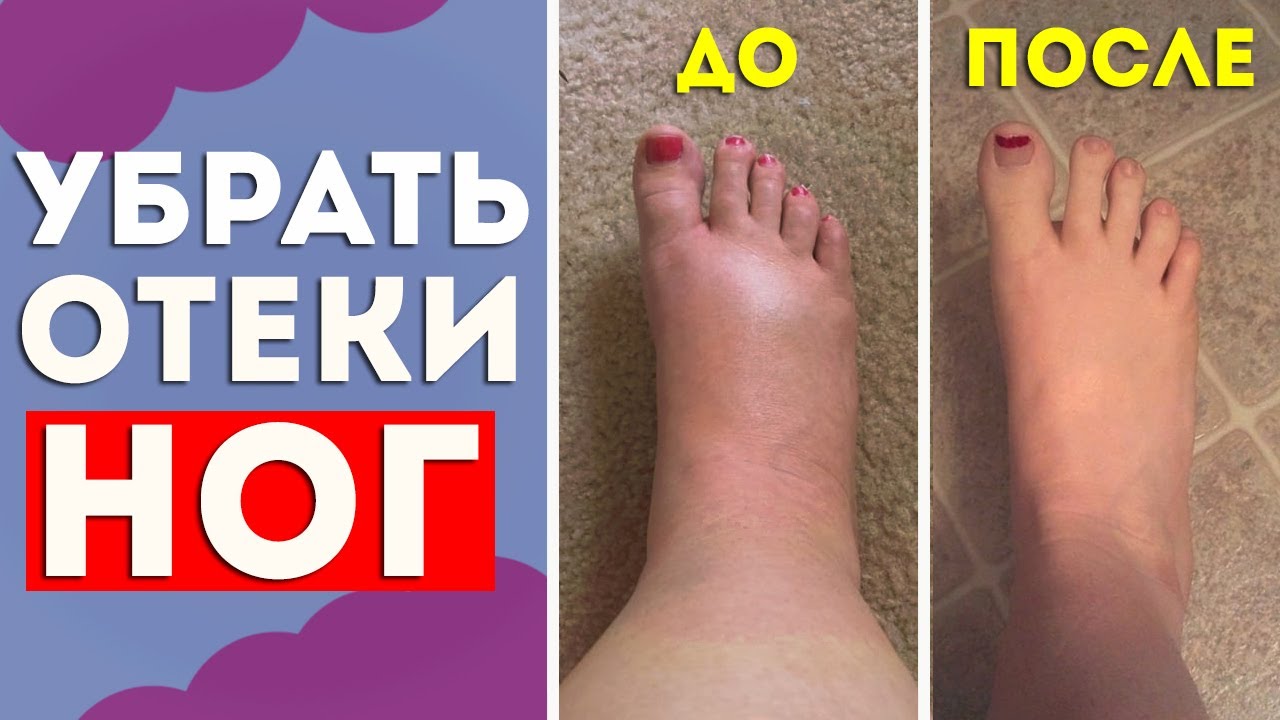 Как убрать ОТЁКИ на ногах Как убрать отёки на лице Как убрать мешки