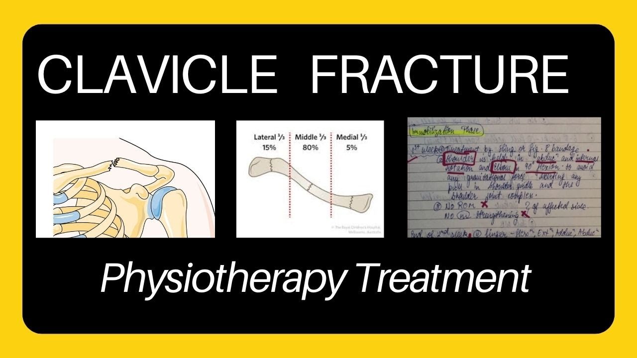 Clavicle Fracture & its Physiotherapy Treatment - YouTube