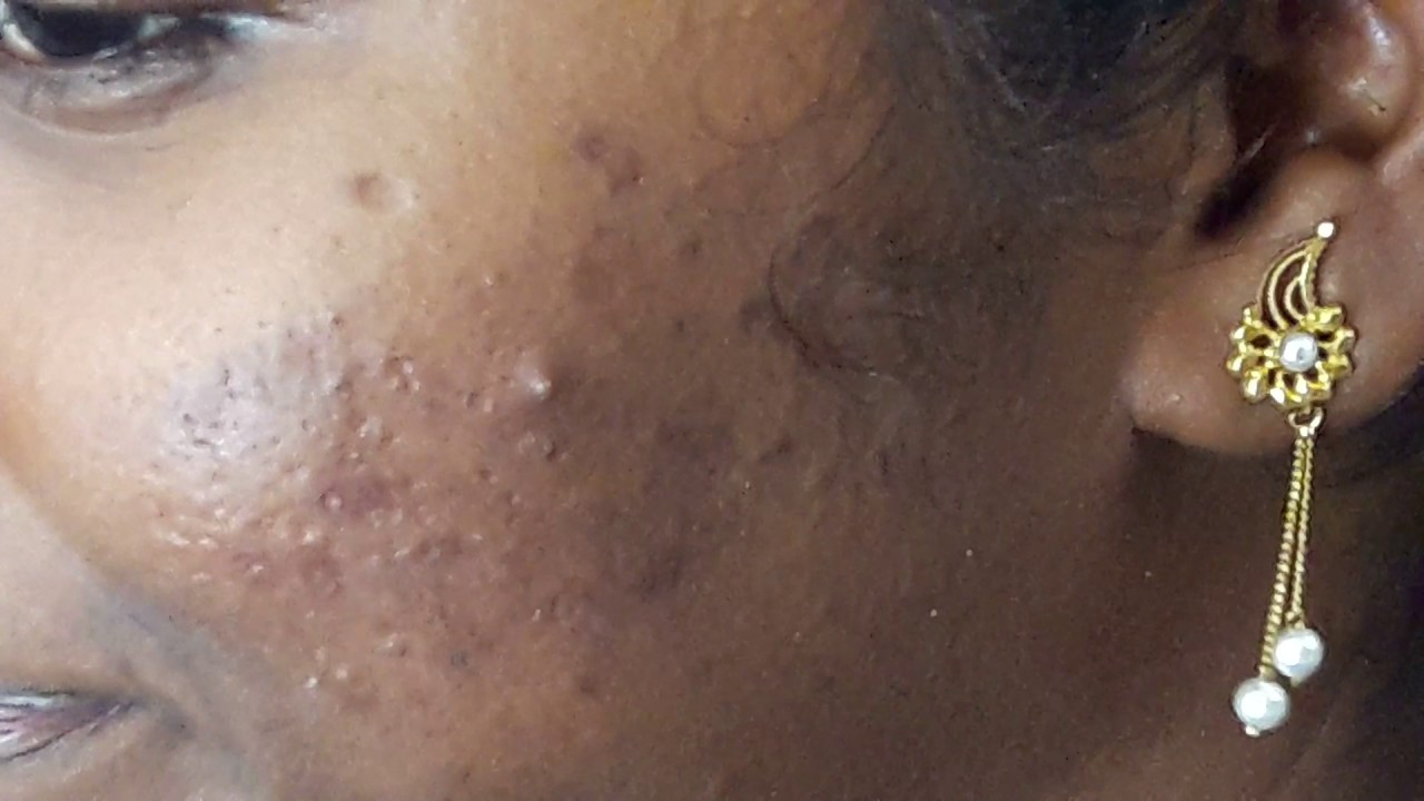 Face 2 weeks after dermaroller. Dark cheeks due to hemosiderin ...