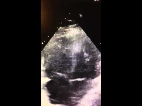 McConnell sign seen on TTE in patient with PE - YouTube