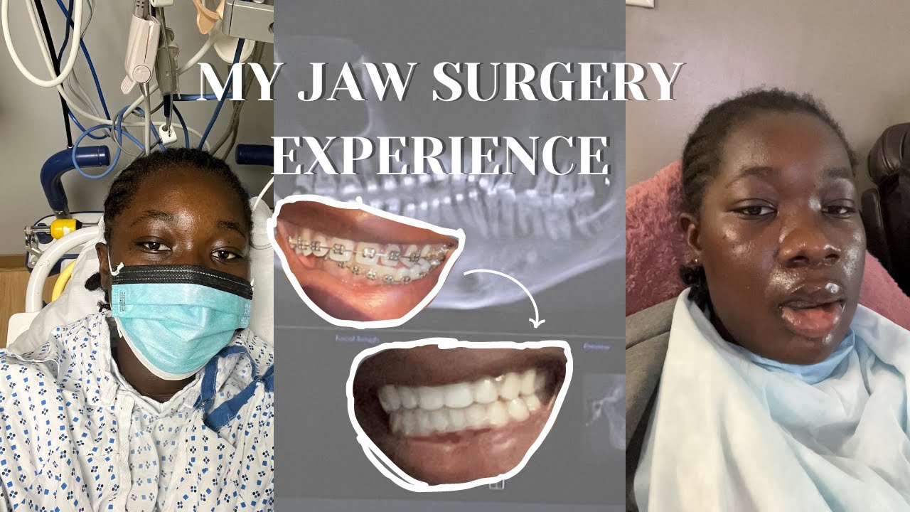WHY I GOT JAW SURGERY AT 22 | CORRECTIVE JAW SURGERY - YouTube