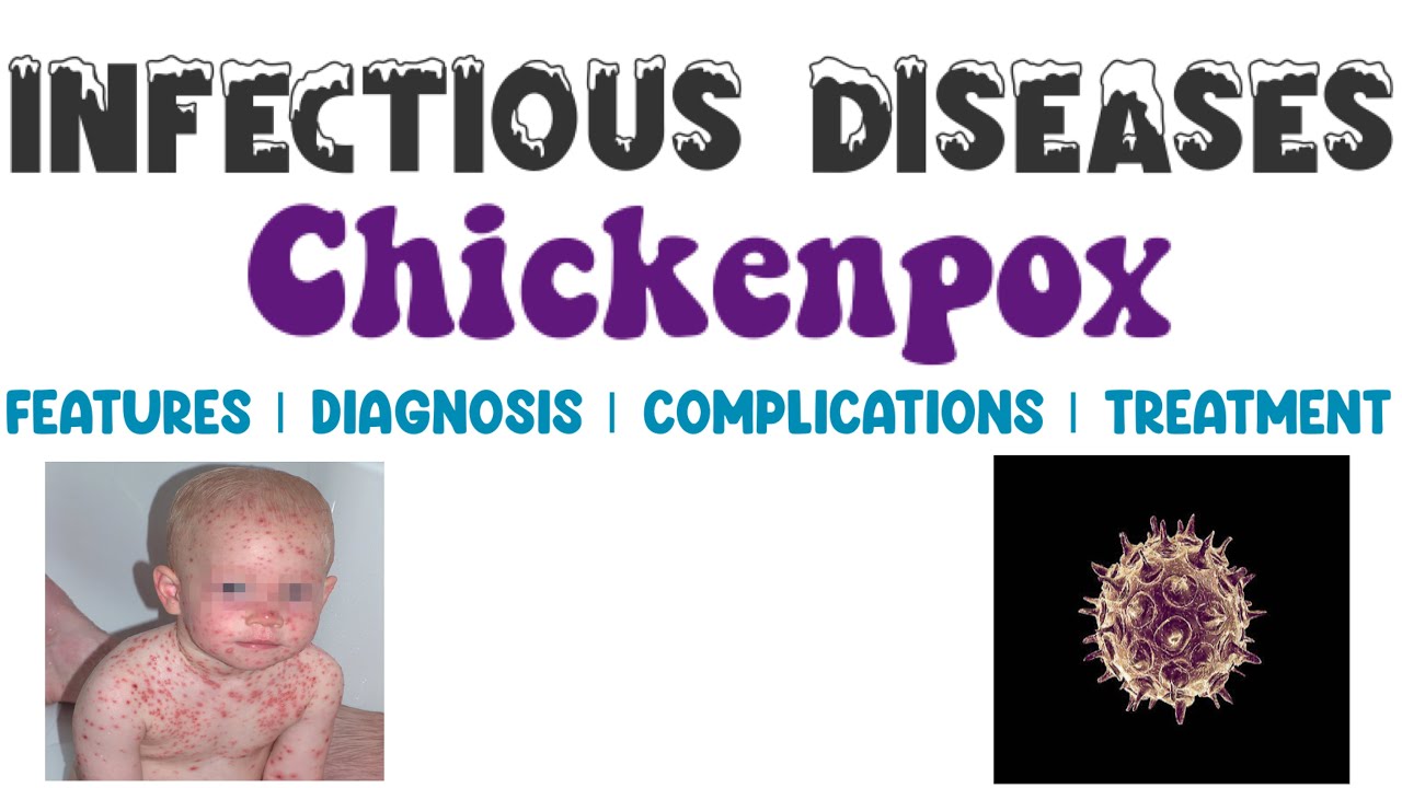 Chickenpox | Viral Infections | Infectious Diseases 5 | Medicine - YouTube