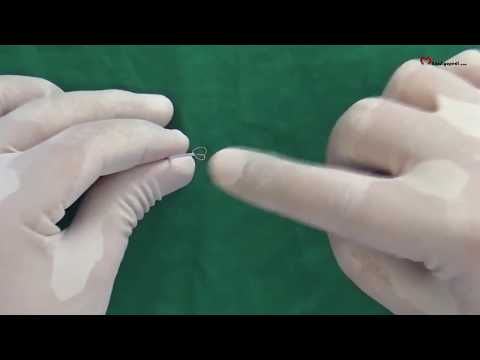 Embolize materyal çıkartılması(snare yöntemi) - YouTube