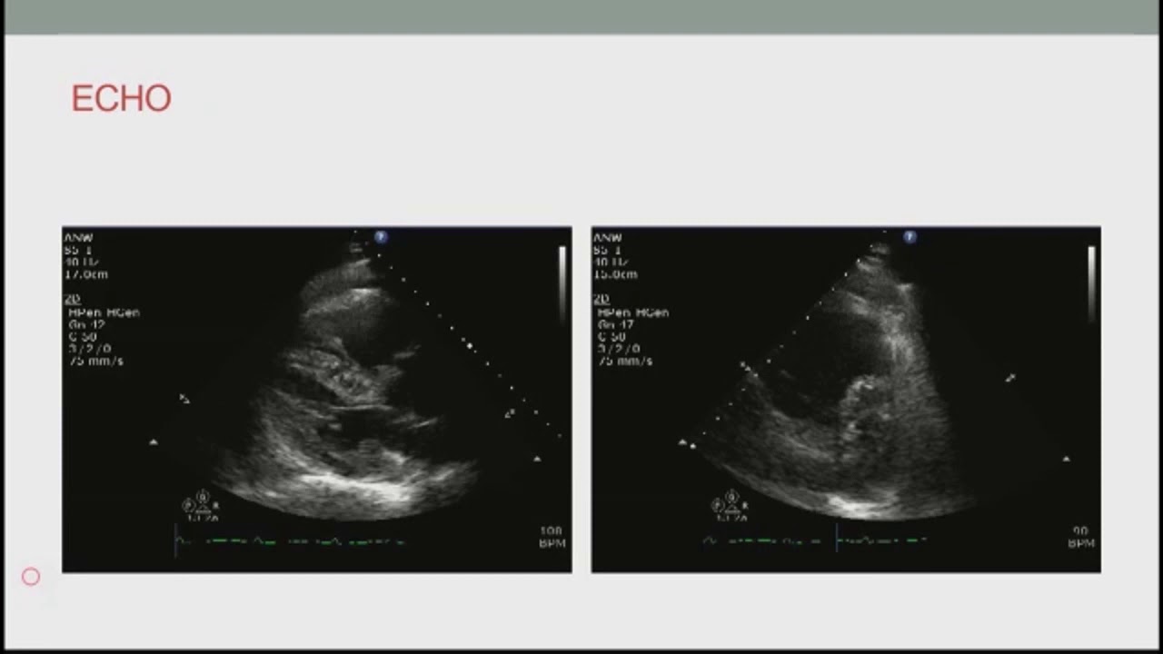 Benjamin Sun, MD - Therapies for Pulmonary Embolism - YouTube