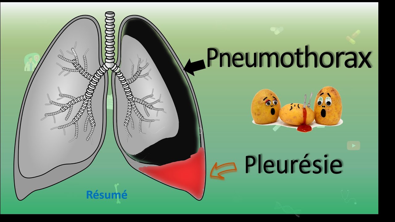 💨 Pneumothorax 🆚 Pleurésie 💧 - Résumé - Pneumo.Phtisiologie - YouTube