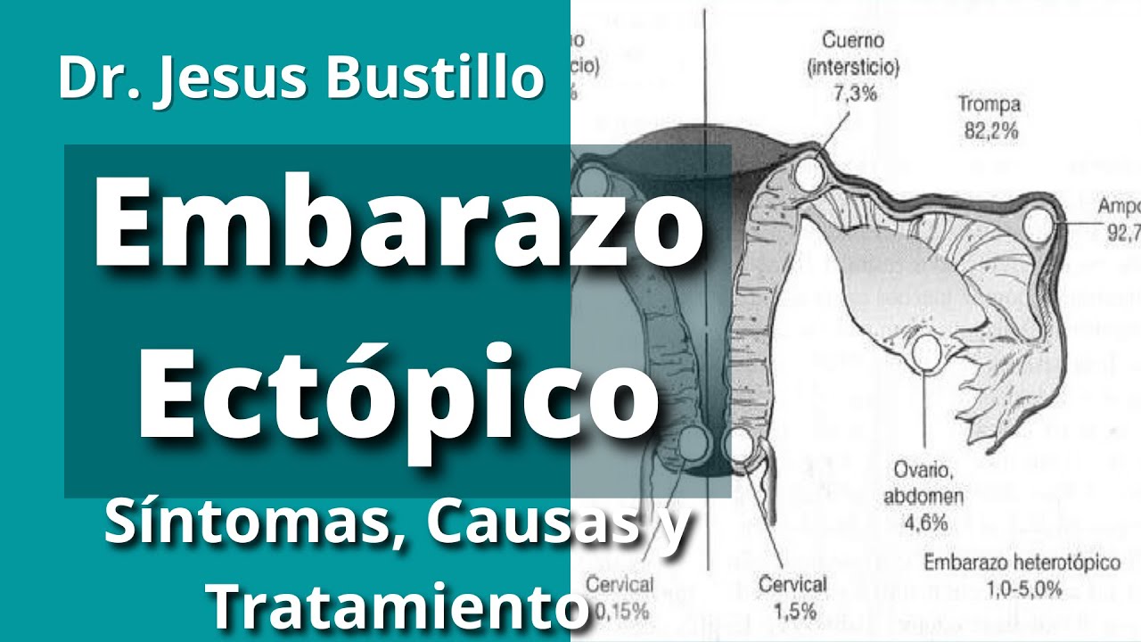 Que es el EMBARAZO ECTOPICO ♀🌺🌸 SINTOMAS, SIGNOS y sus CAUSAS (2021 ...