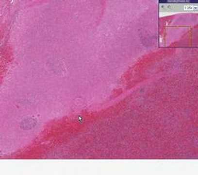 Histopathology Spleen --Acute infarct - YouTube