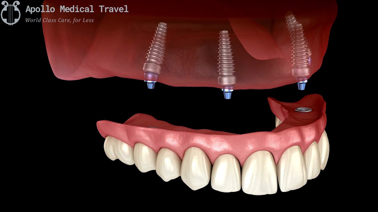 Animated Implant Supported Denture Procedure | Apollo Medical Travel ...