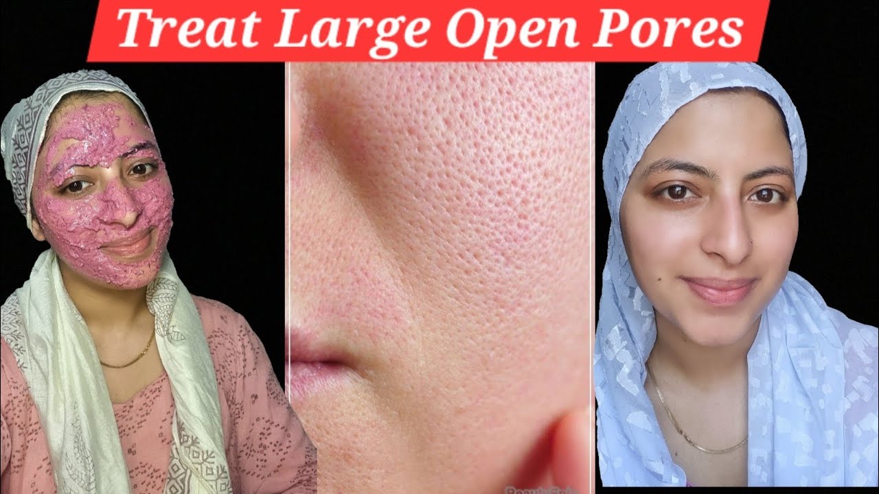 How to treat OPEN PORES | Enlarged Pores - Causes & Treatment | Natural ...