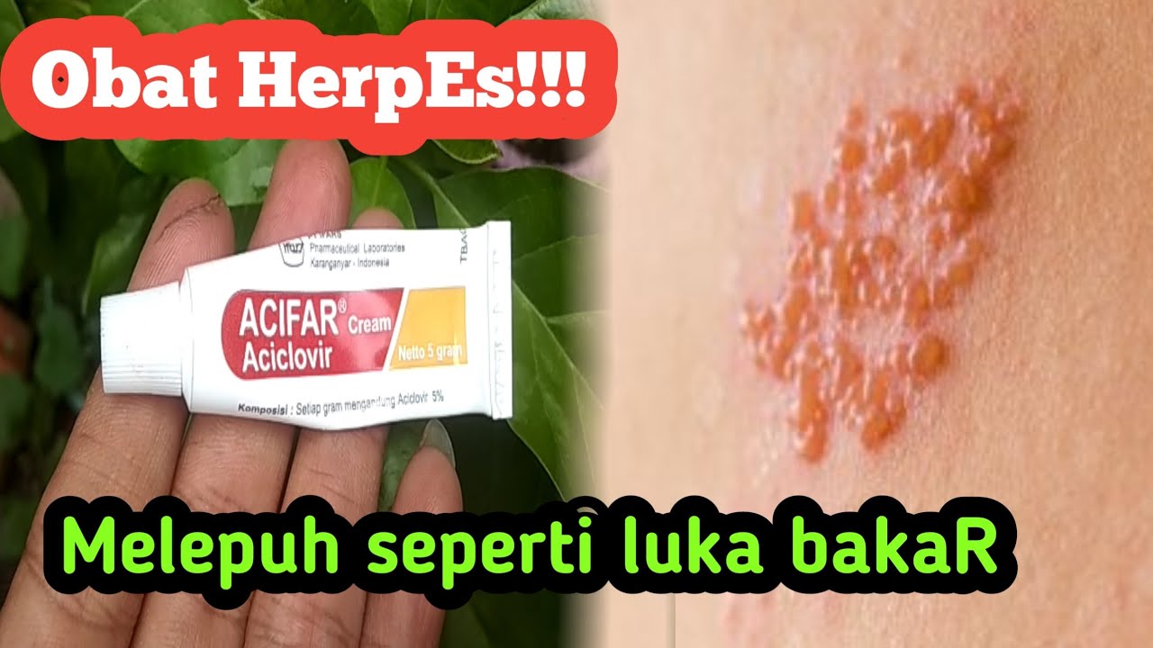 Review Acifar aciclovir cream obat herpes - YouTube