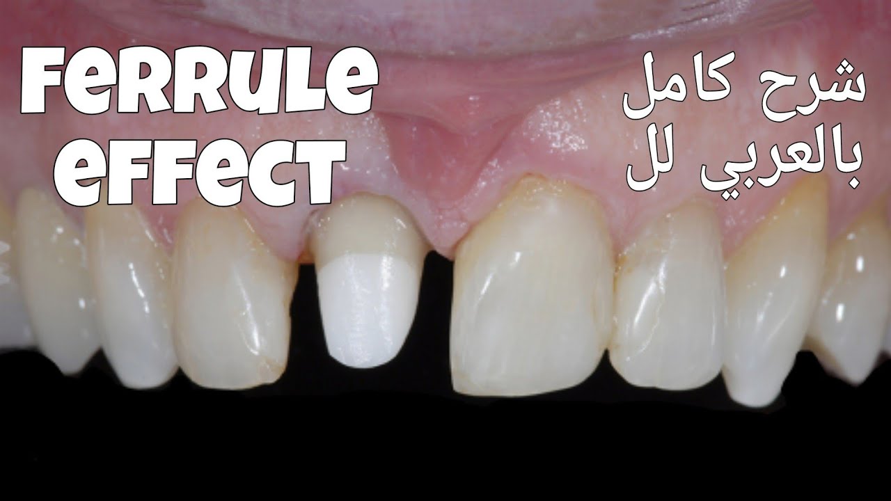 ferrule effect شرح كامل بالعربي لل - YouTube