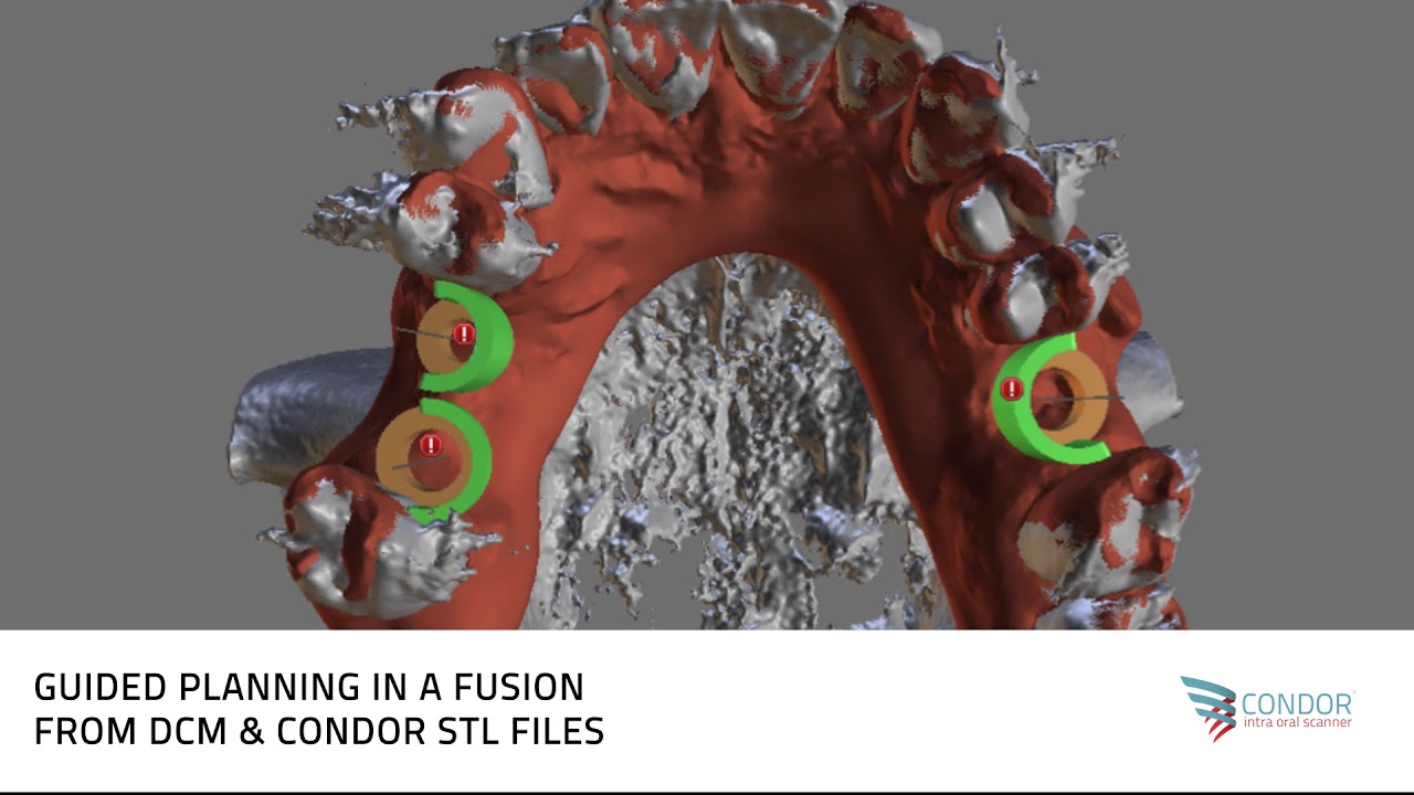 Condor User Case | Guided Surgery - YouTube
