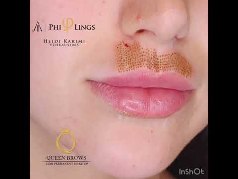 Plasma Pen Lip Flip Treatment - YouTube