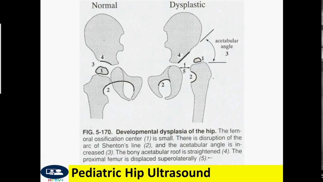 Pediatric hip ultrasound - YouTube