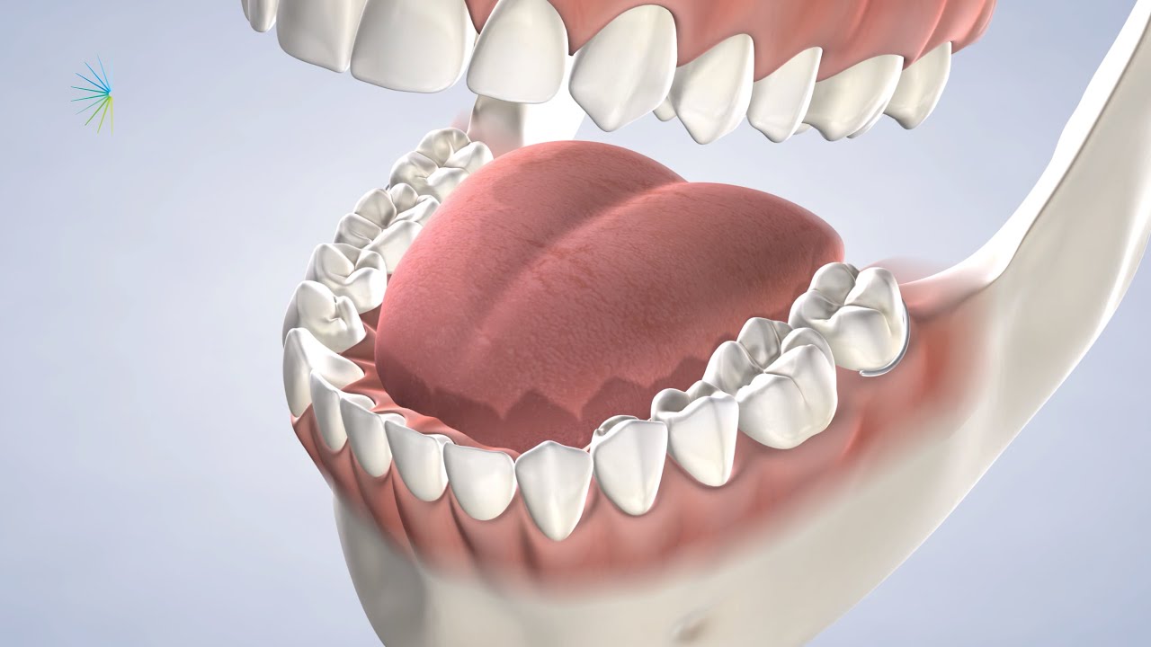 Jaw Removal