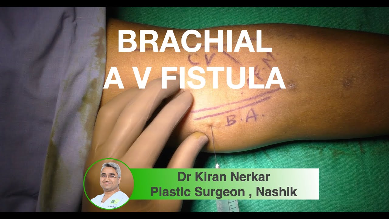 Brachiocephalic AV Fistula | Proximal AV Fistula | Brachial AV Fistula ...
