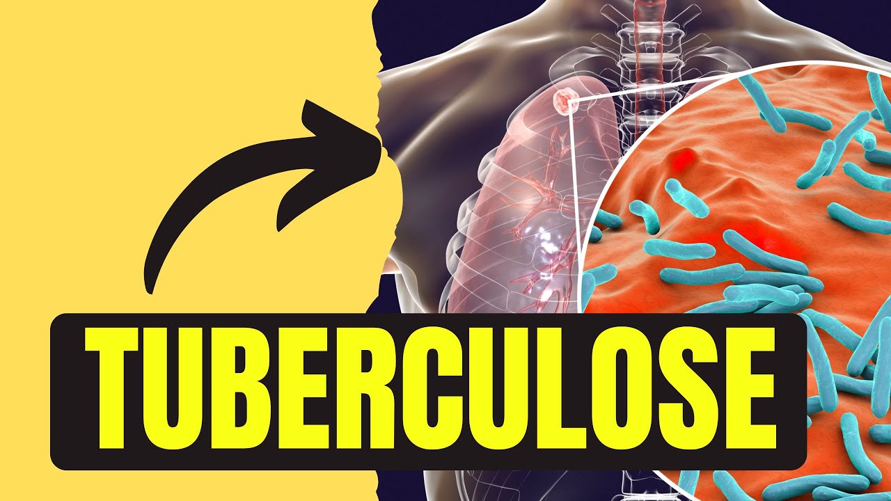 TUBERCULOSE - ESQUEMA DE TRATAMENTO (PARTE 2) - YouTube