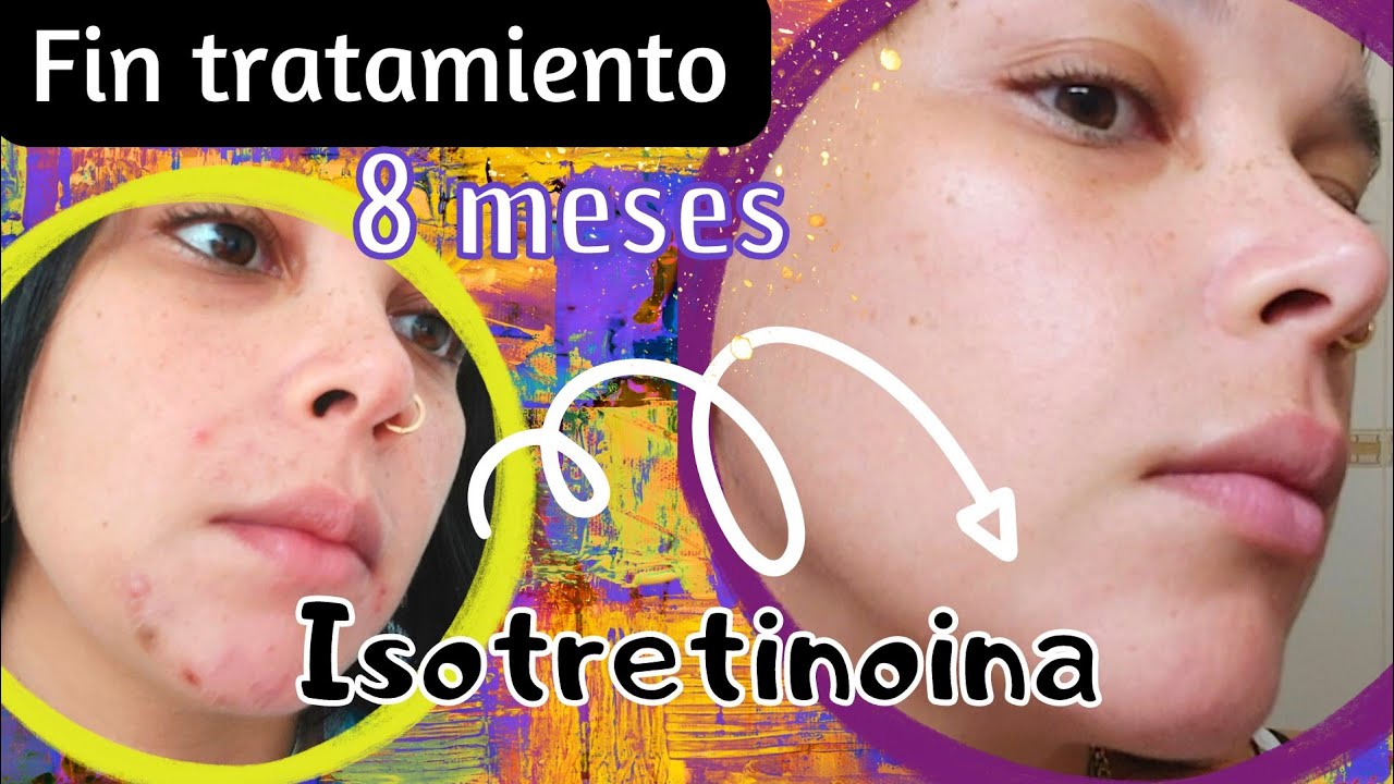 Tratamiento con ISOFACE 8 meses (Storytime) - YouTube