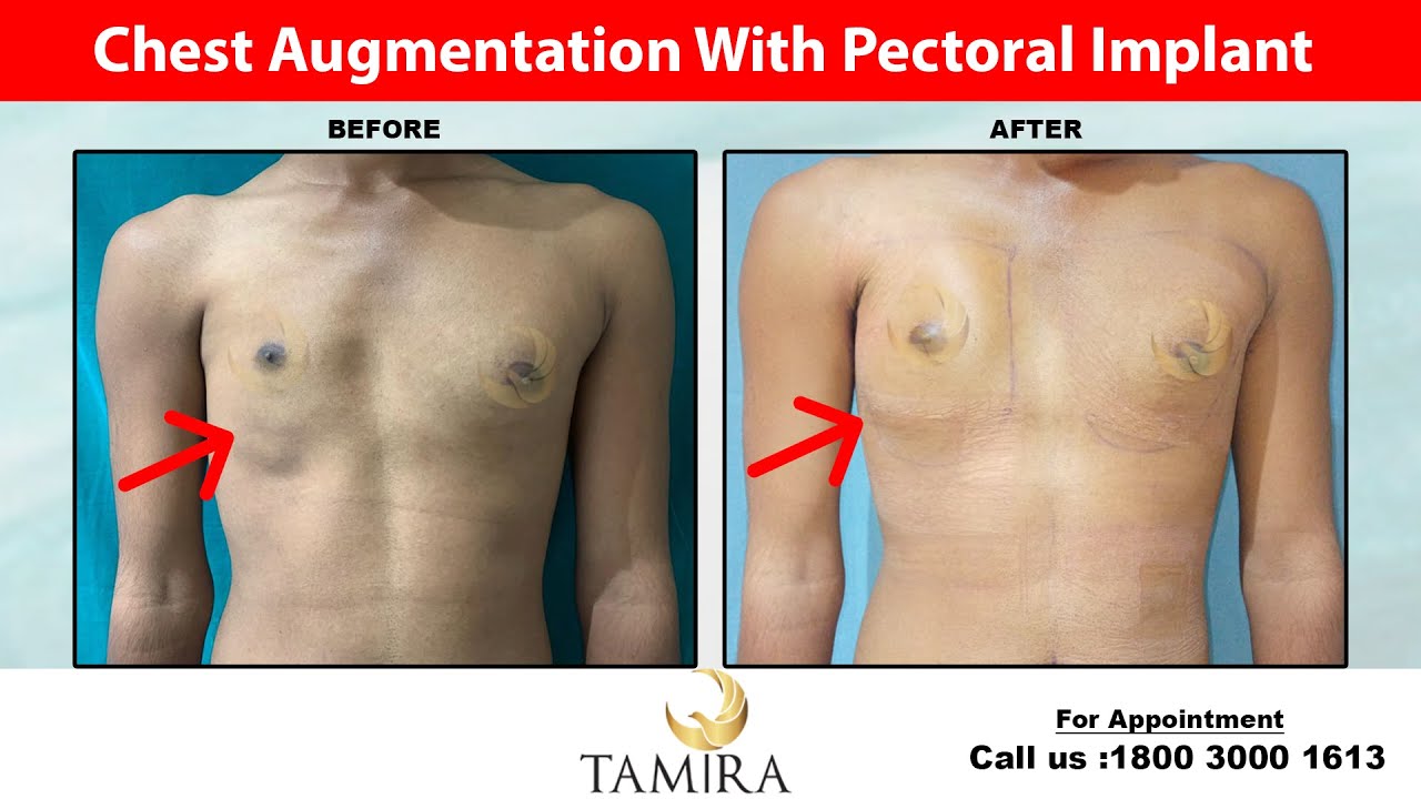 Pectoral Implants