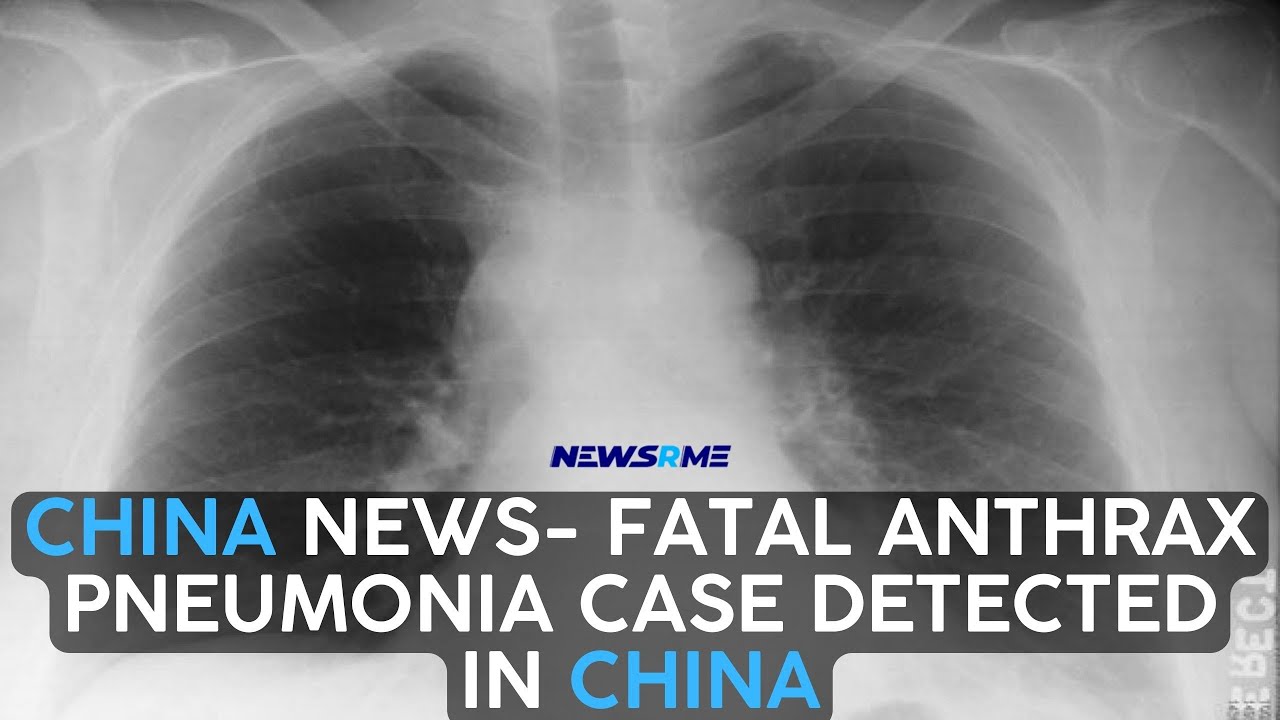 China news- Fatal anthrax pneumonia case detected in China | NewsRme ...